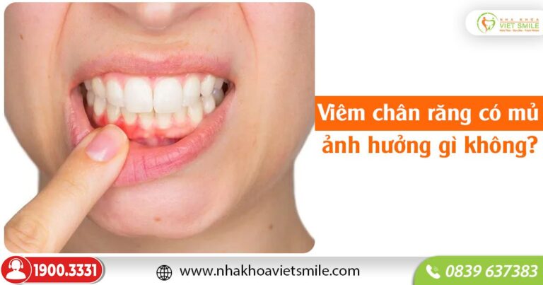 Viêm chân răng có mủ ảnh hưởng gì không?
