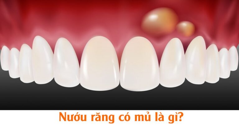 Nướu răng có mủ không đau