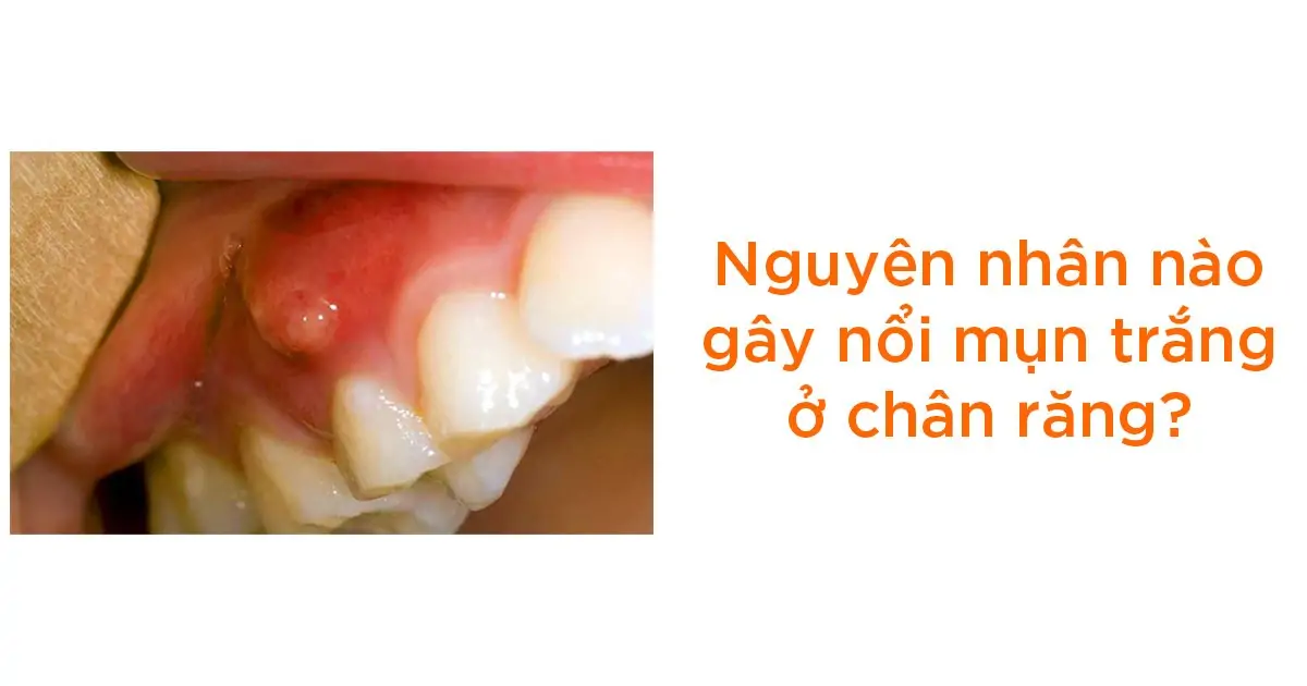 Nổi Mụn Trắng ở Chân Răng Do đâu